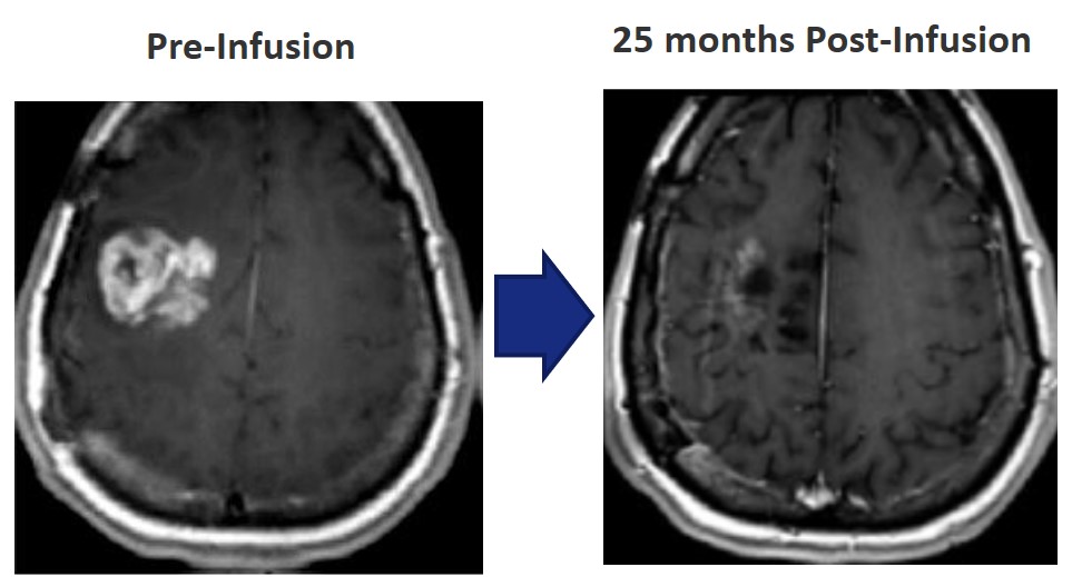 Can Polio Virus Help Treat Brain Tumors? - UConn Today