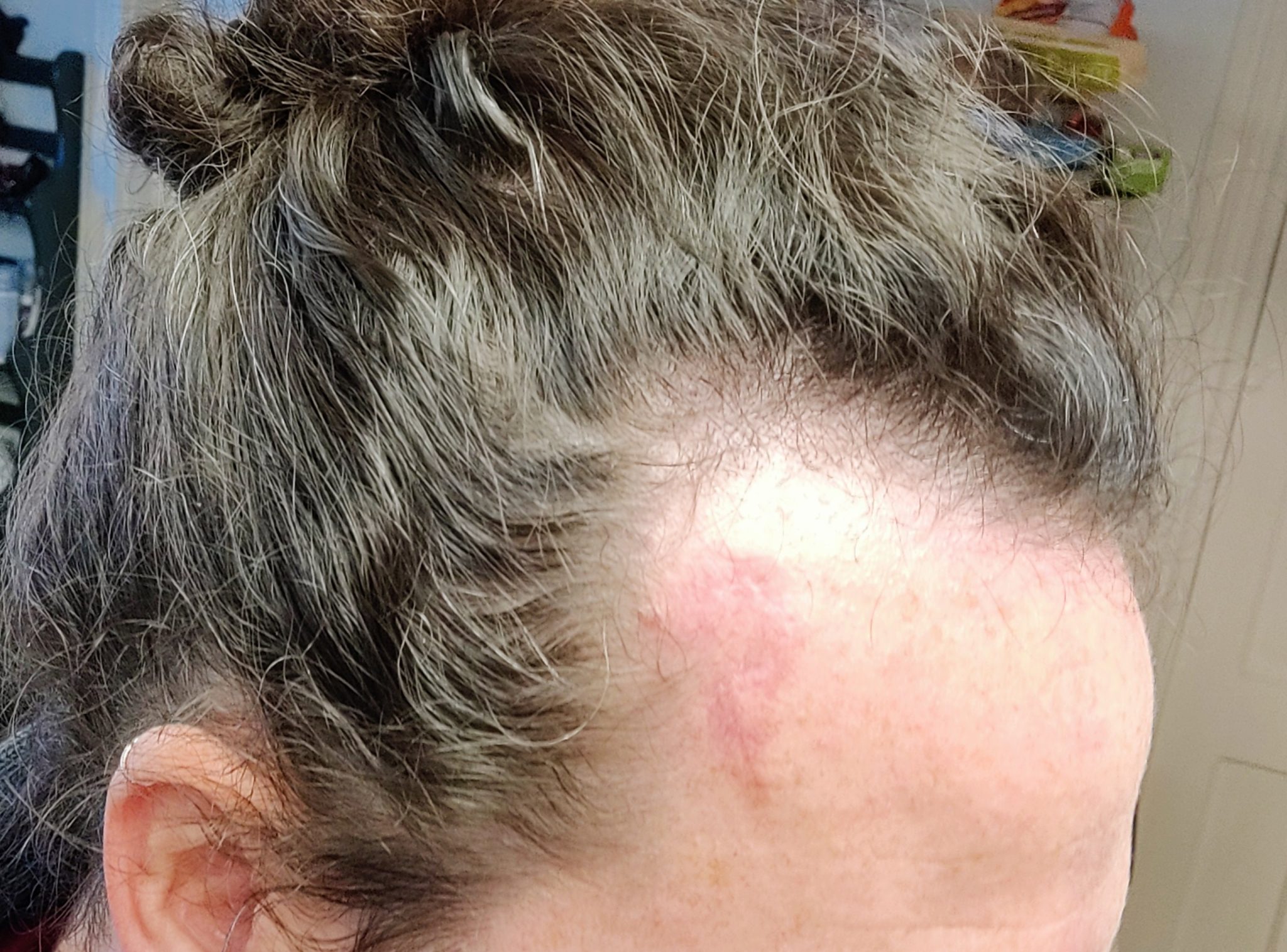 Skin Cancer, When Found and Treated Early is Highly Curable - UConn Today