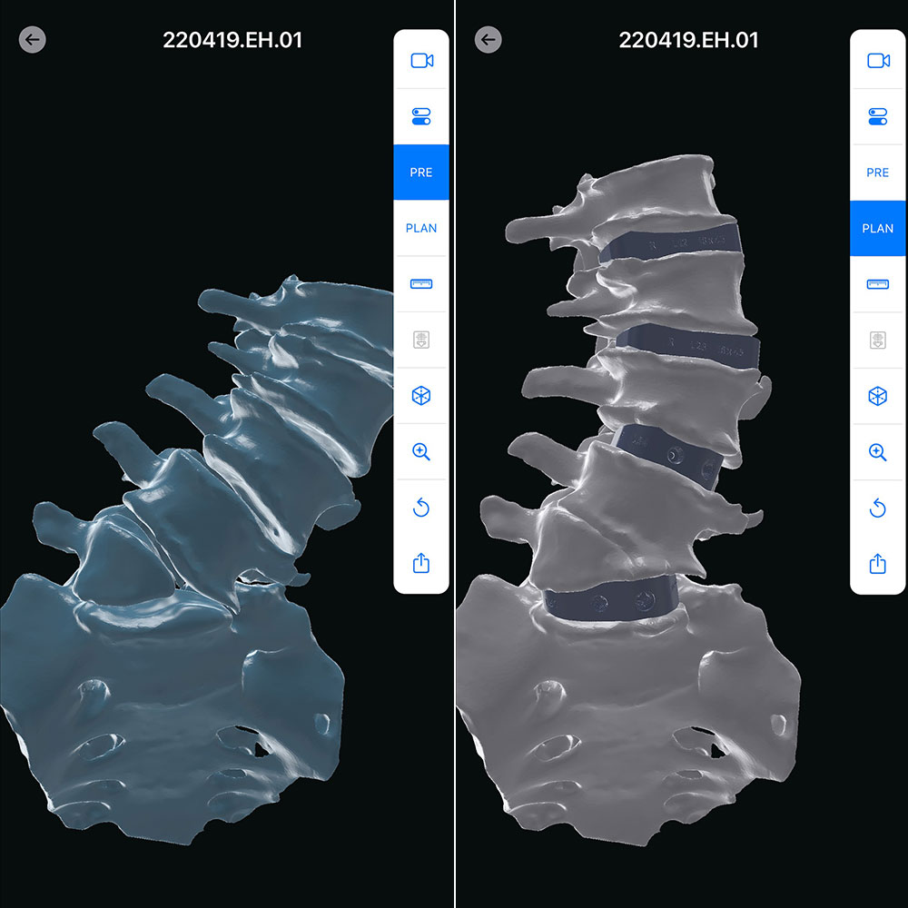 A 3D-Printed Solution for the Spine - UConn Today