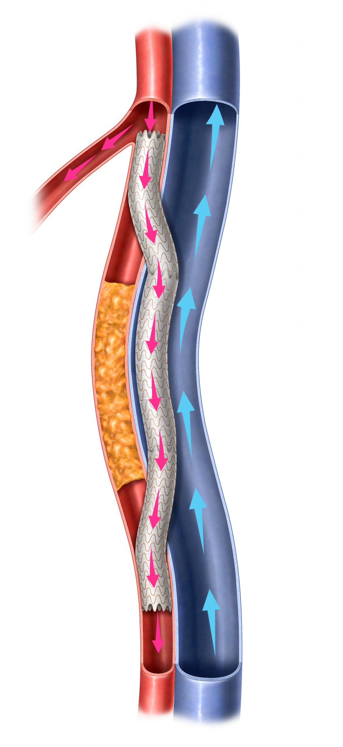 UConn’s Vascular Surgeons Take DETOUR to Save Woman’s Toes, Foot, and ...