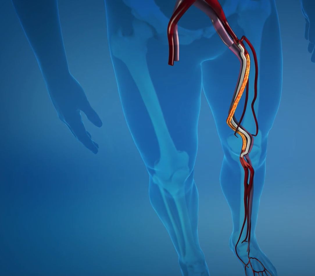 UConn’s Vascular Surgeons Take DETOUR to Save Woman’s Toes, Foot, and ...