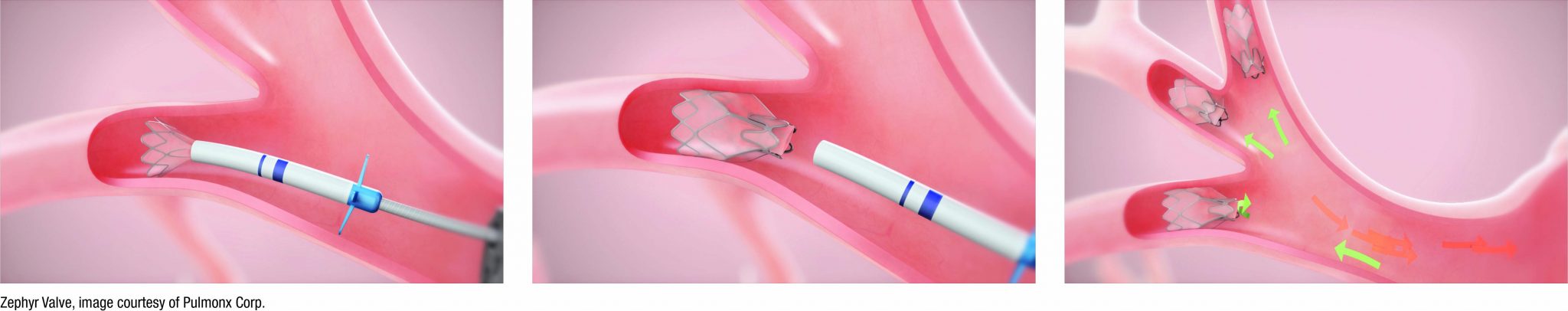 Patient Grateful to Breathe Again: The Life-Changing Power of ...