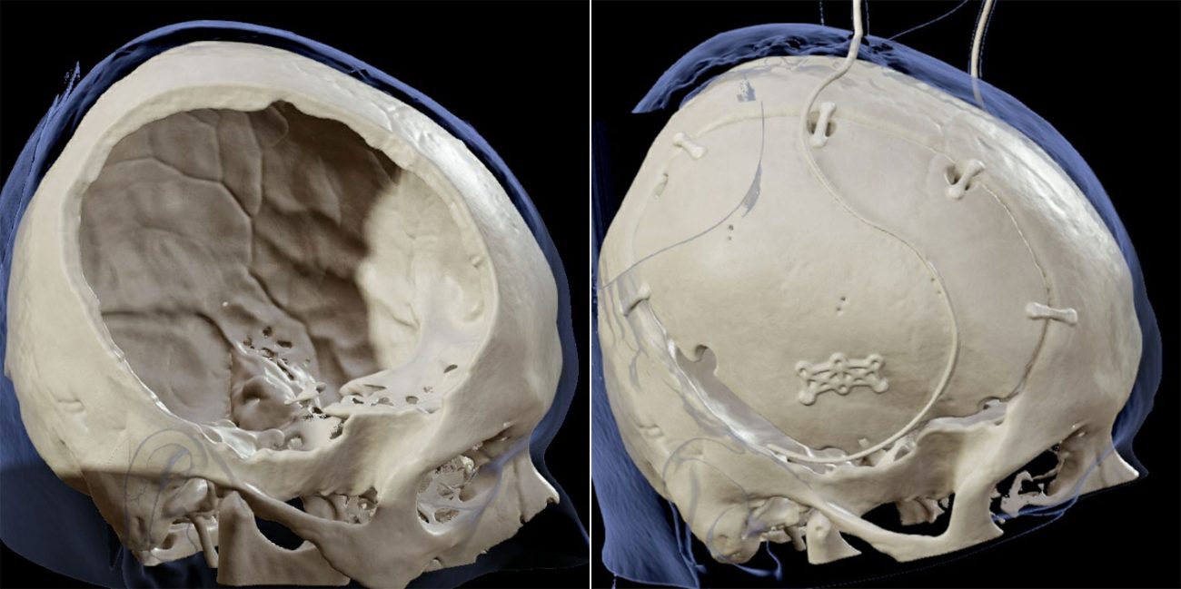 Department of Defense Program Funds Study of Cranial Regeneration ...